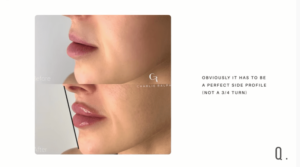 Why Is My Side Profile So Ugly: Just Love Your Beauty