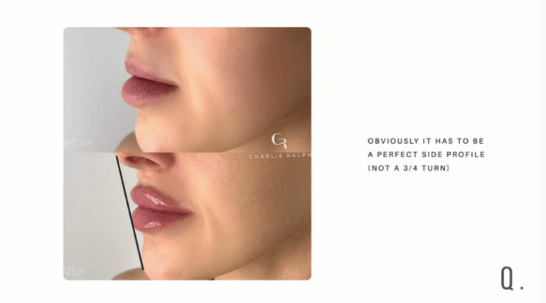 Why Is My Side Profile So Ugly: Just Love Your Beauty